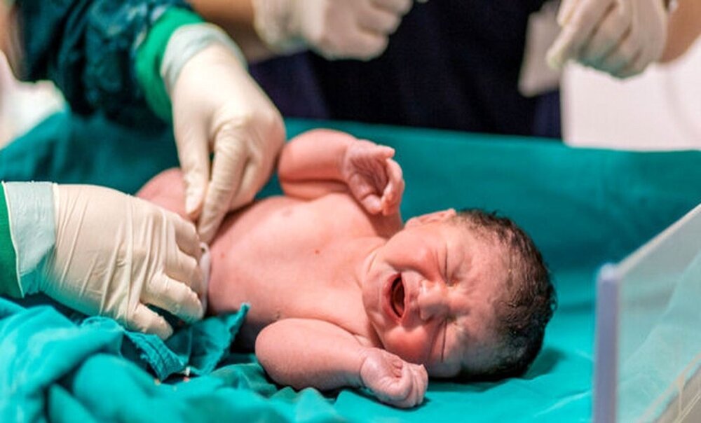 Caesarean Delivery 3 Times The Global Standard Tehran Times Caesarean Delivery 3 Times The Global Standard Tehran Times